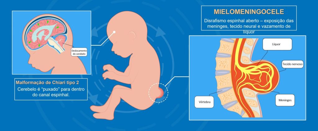 Mielomeningocele Dra Raquel Rodrigues Neurocirurgia Pediátrica