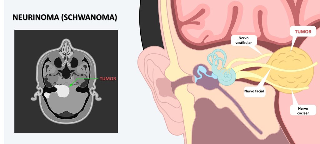 Neurinomas - Dra. Raquel Rodrigues - Neurocirurgia pediátrica
