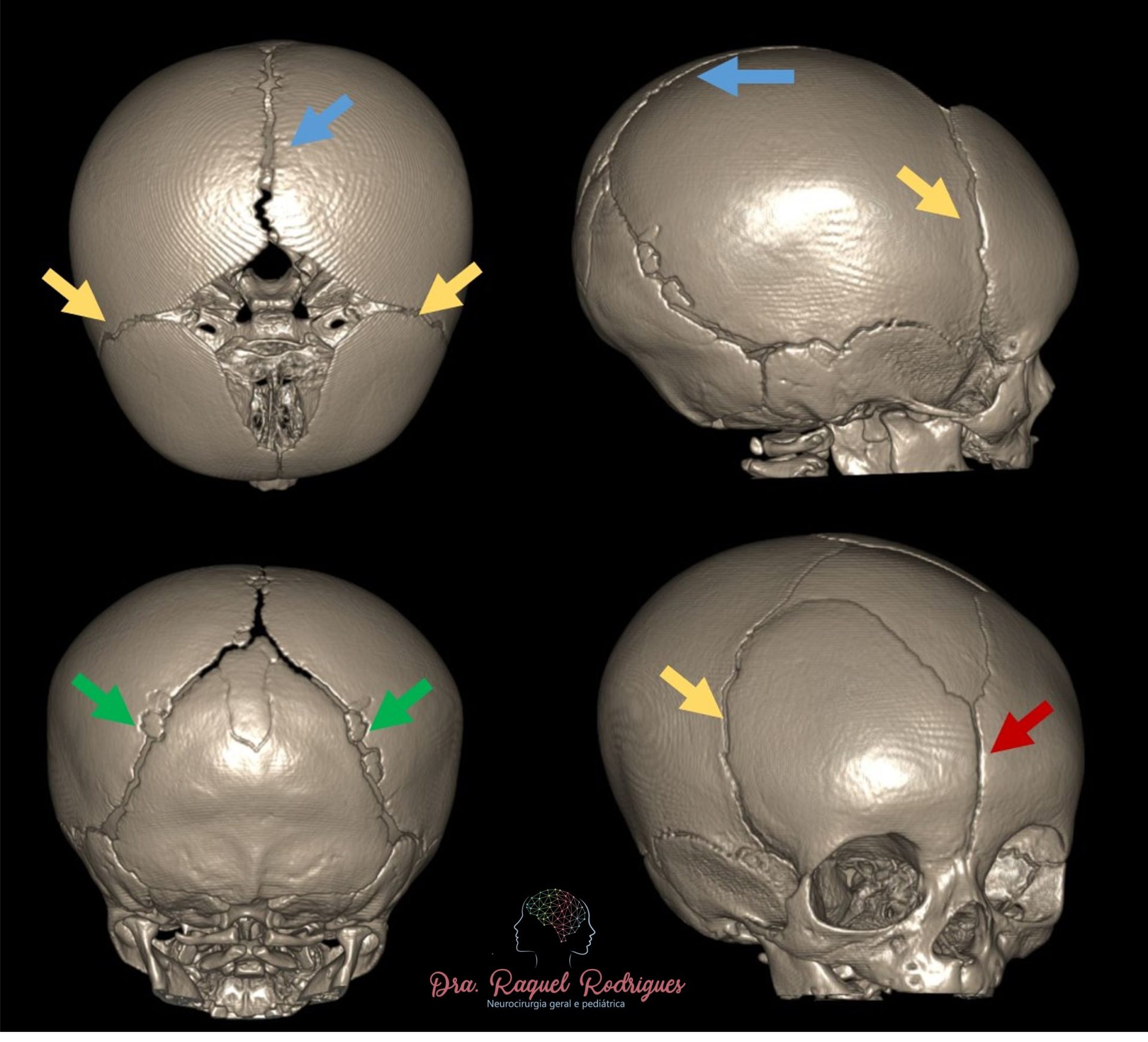 Escafocefalia - Dra. Raquel Rodrigues - Neurocirurgia pediátrica
