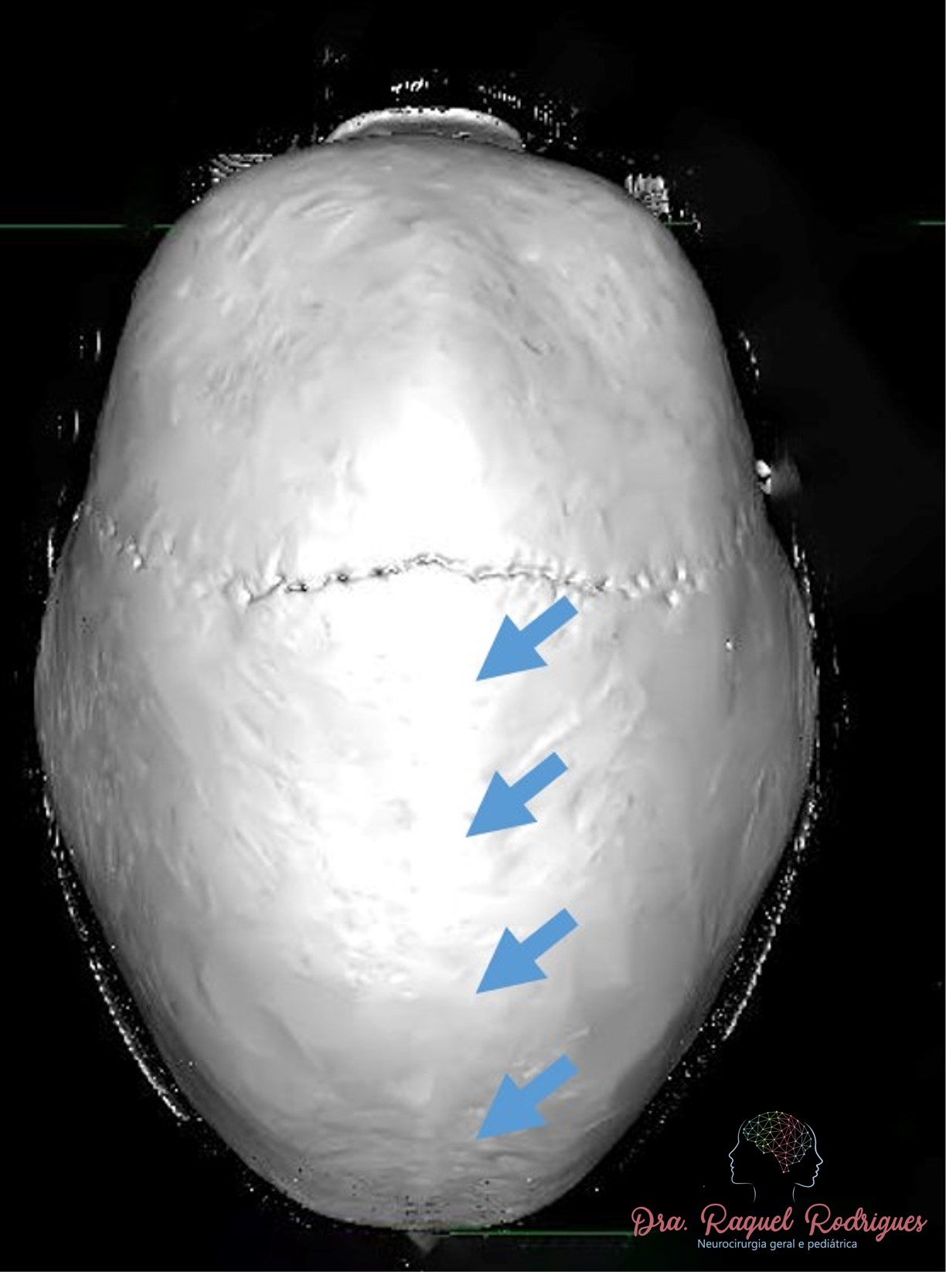 Escafocefalia - Dra. Raquel Rodrigues - Neurocirurgia pediátrica