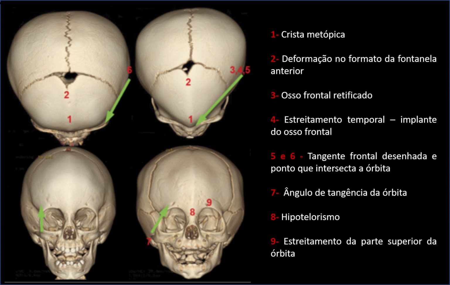 Trigonocefalia/Crista metópica - Dra. Raquel Rodrigues - Neurocirurgia ...