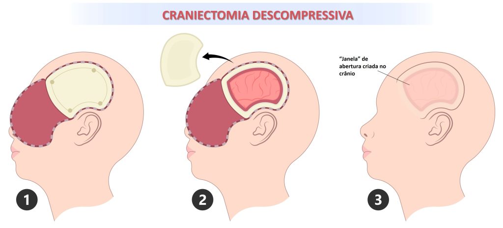 Reconstrução do crânio (cranioplastia) - Dra. Raquel Rodrigues ...