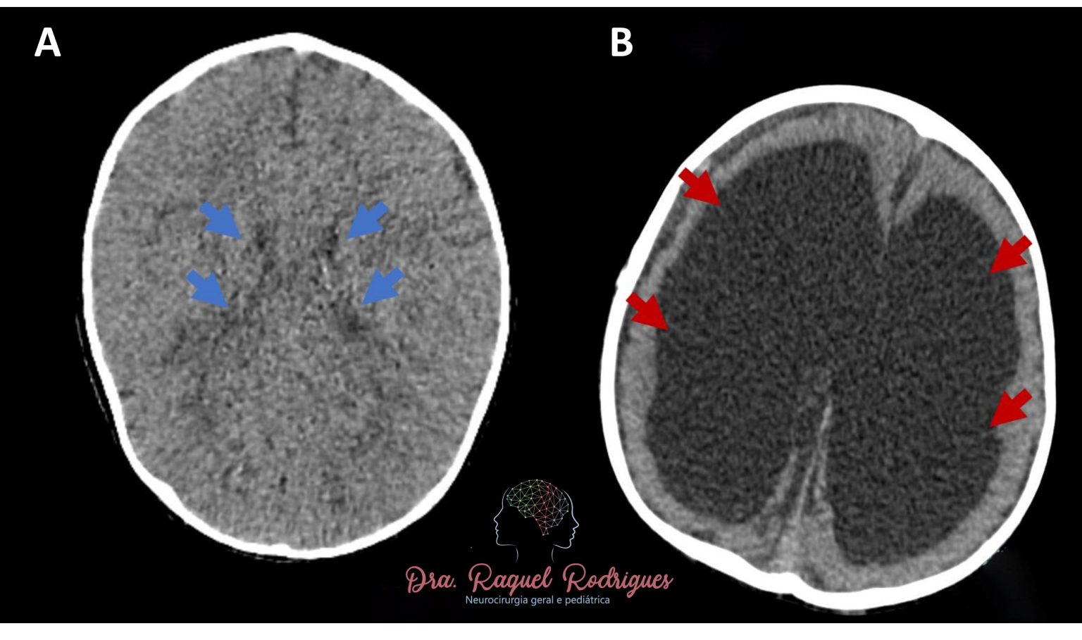 Hidrocefalia em Crianças - Dra. Raquel Rodrigues - Neurocirurgia pediátrica