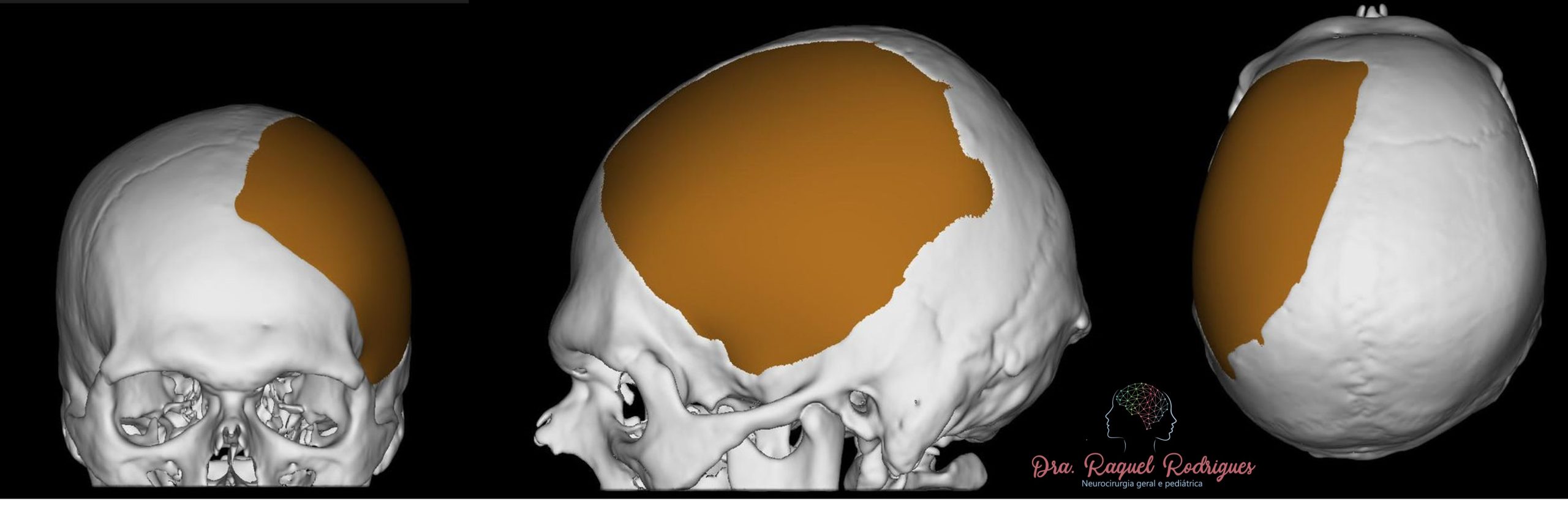Reconstrução do crânio (cranioplastia) - Dra. Raquel Rodrigues ...