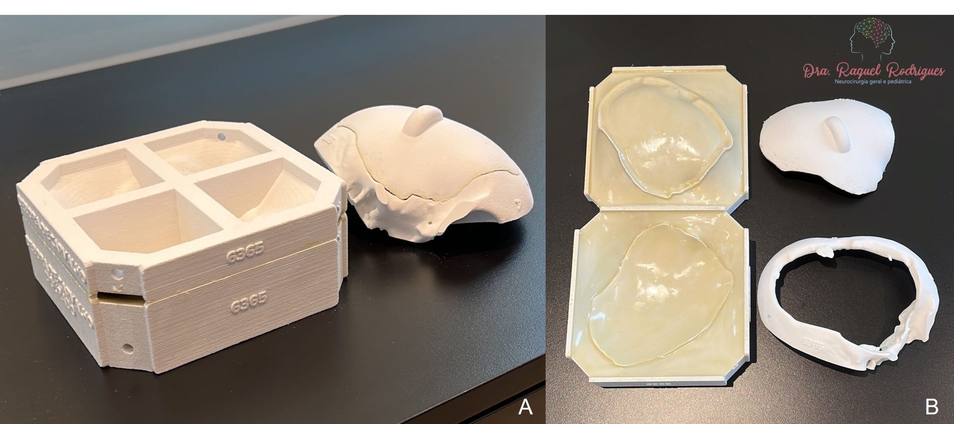 Reconstrução do crânio (cranioplastia) - Dra. Raquel Rodrigues ...