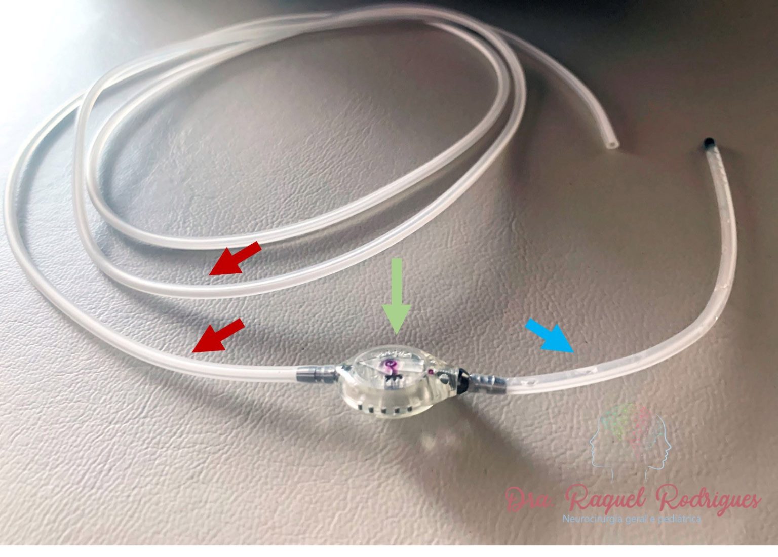 Hidrocefalia do Adulto - Dra. Raquel Rodrigues - Neurocirurgia pediátrica