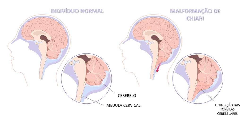 Malformação de Chiari - Dra. Raquel Rodrigues - Neurocirurgia pediátrica