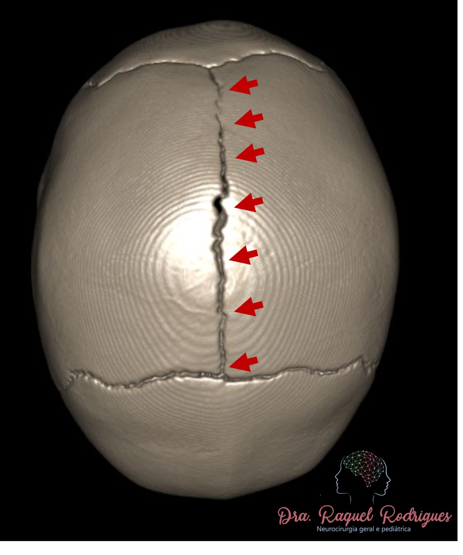 Escafocefalia - Dra. Raquel Rodrigues - Neurocirurgia pediátrica