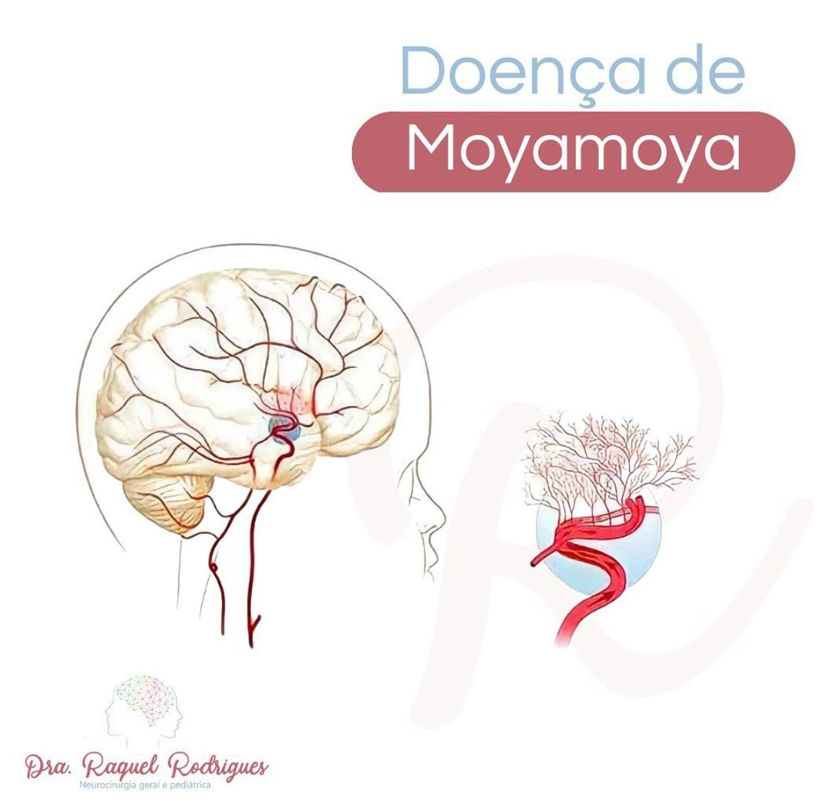 Você conhece a doença de moyamoya? - Dra. Raquel Rodrigues ...