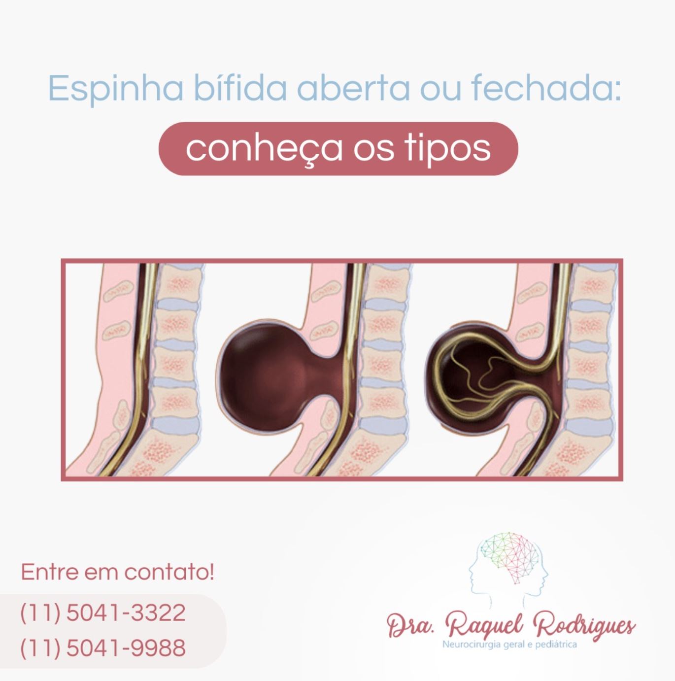 Espinha bífida - o que é? - Dra. Raquel Rodrigues - Neurocirurgia ...