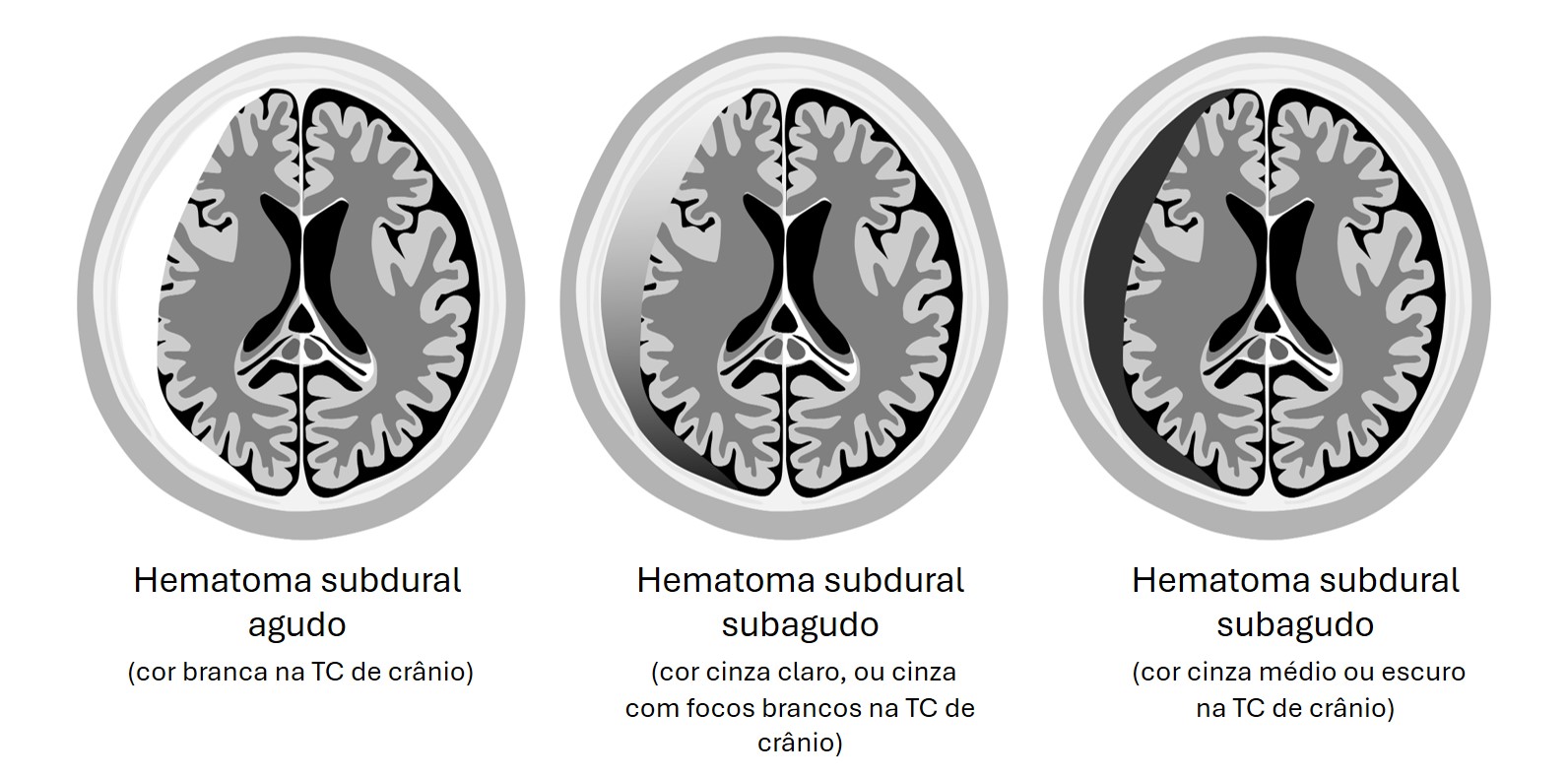 Hematoma subdural crônico - Dra. Raquel Rodrigues - Neurocirurgia ...