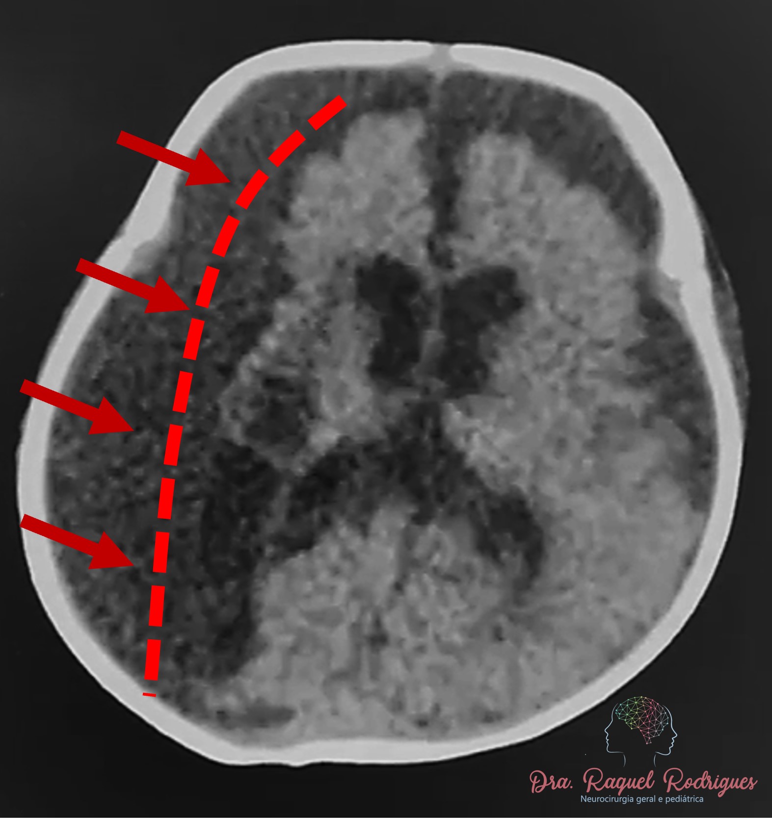 Hematoma subdural crônico - Dra. Raquel Rodrigues - Neurocirurgia ...