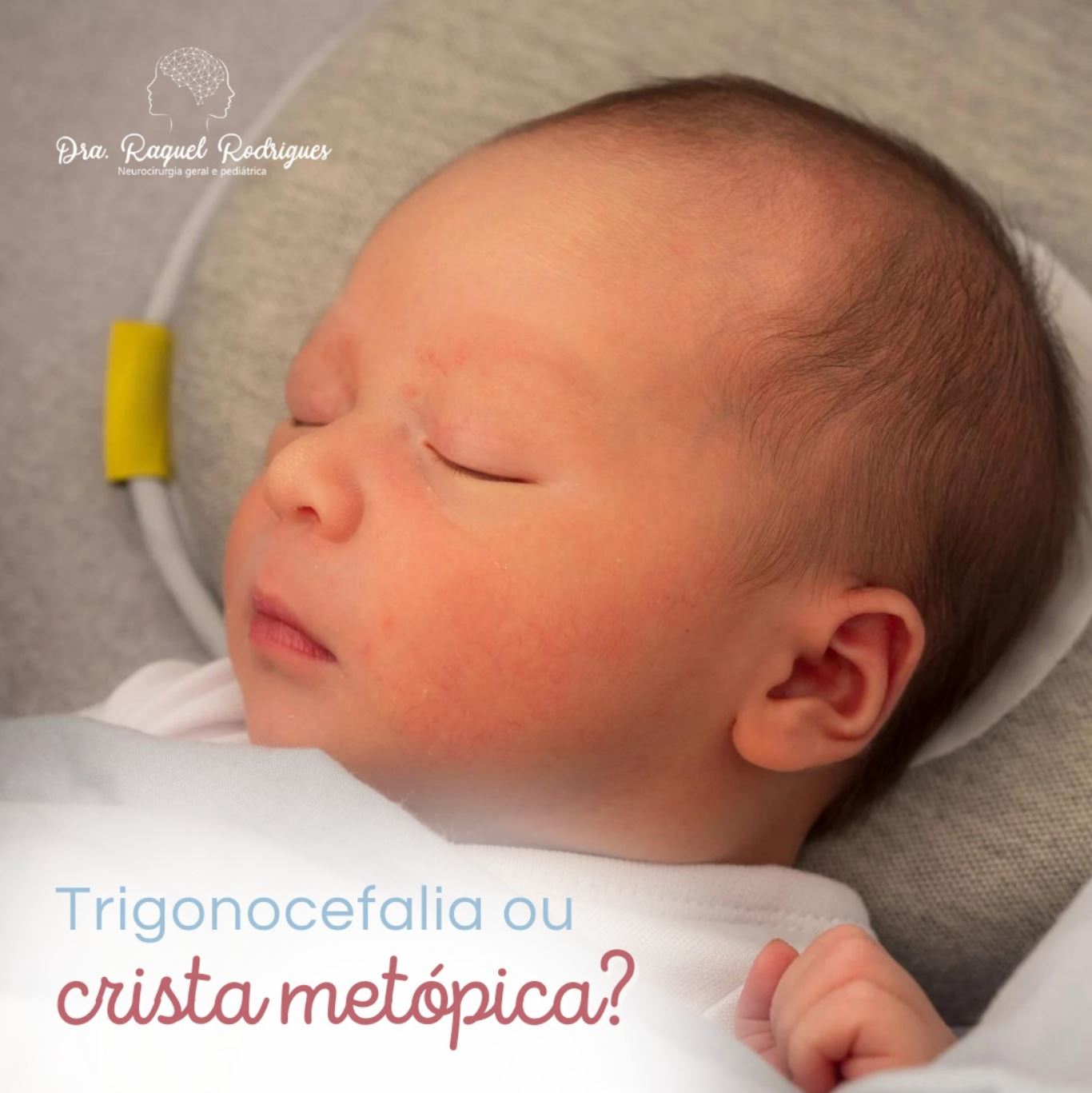 Trigonocefalia ou crista metópica? - Dra. Raquel Rodrigues ...